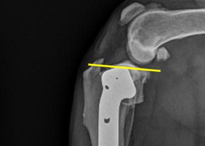 TPLO: Tibial Plateau Leveling Osteotomy for an ACL tear in the knee ...